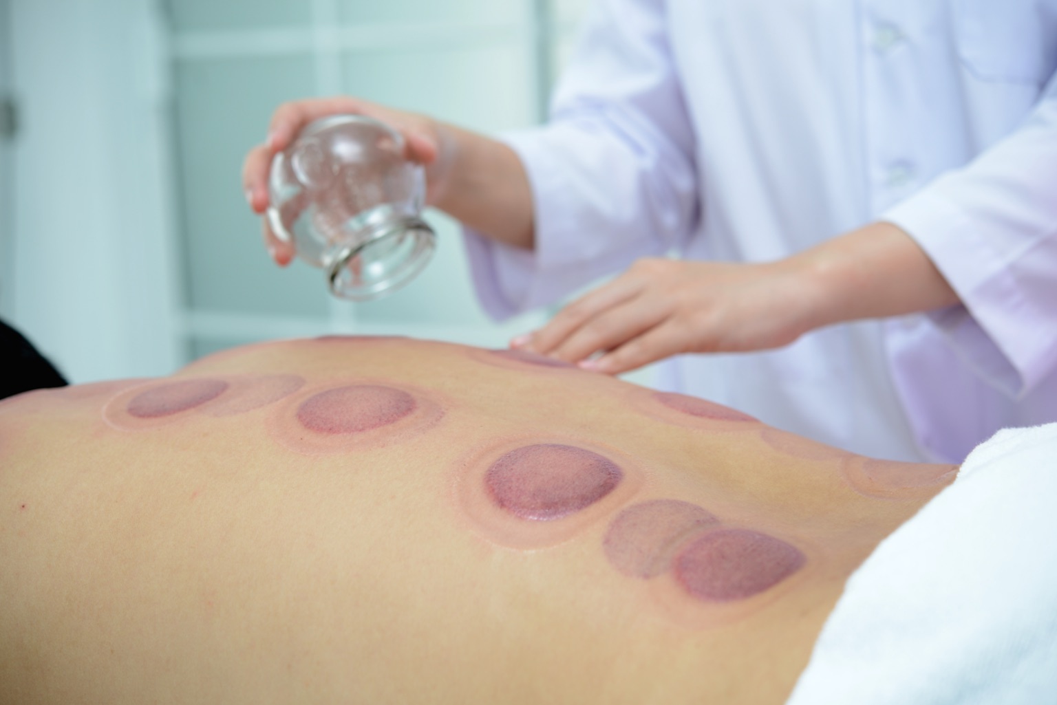 Traditional Cupping - #1 Best Cupping Massage in Naples